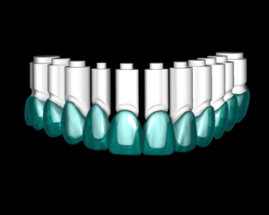 MOD Design Services - Advanced dental design services from a clinician ...